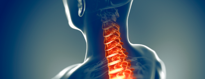 Hernia cervical | Síntomas | Dr Alberto Marqués