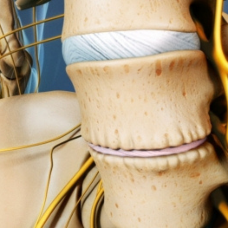 Qué son los osteofitos | Dr Alberto Marqués